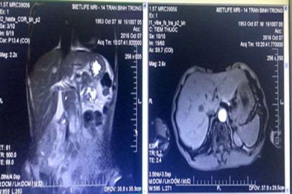 Những điều cần biết trước khi chụp MRI ổ bụng | medim.vn